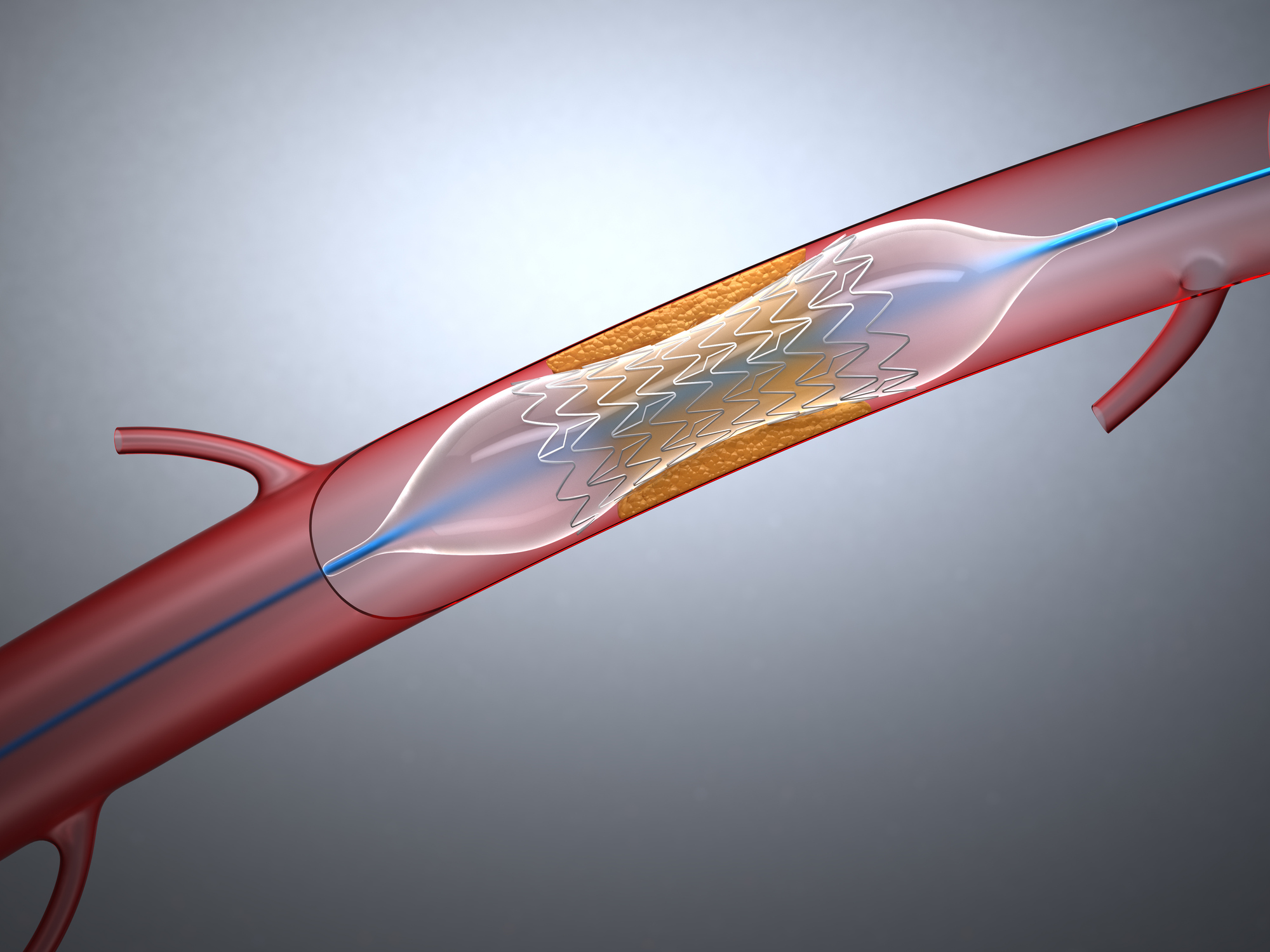 Angioplastia cu stent, principala metoda de revascularizare coronariana ...